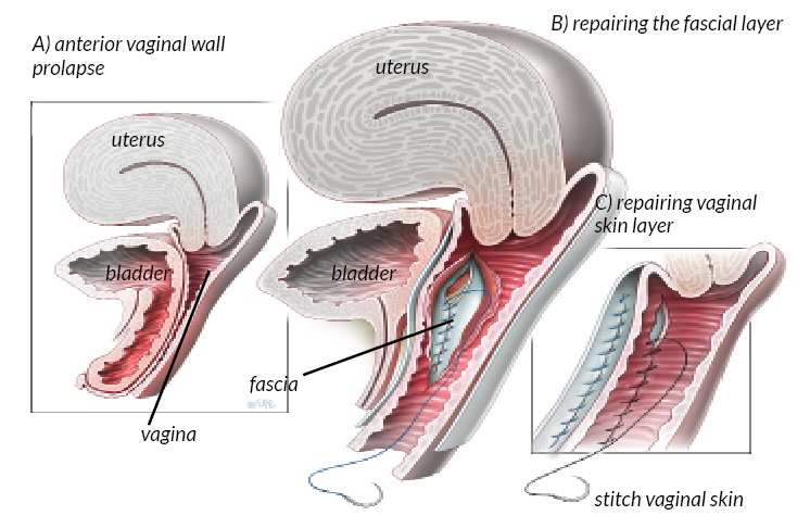 Vaginal Hysterectomy For Prolapse Your Pelvic Floor